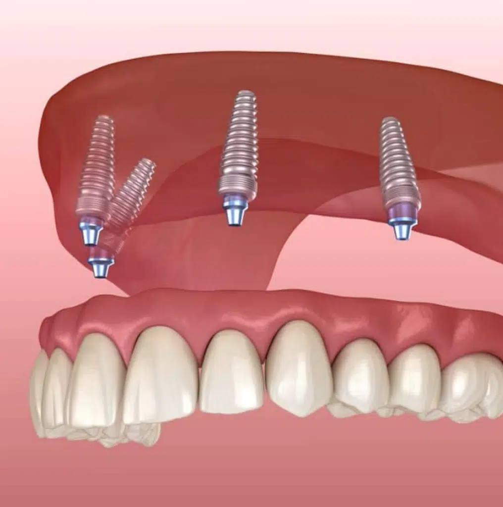 Why Choose Snap-In Implant Dentures?
