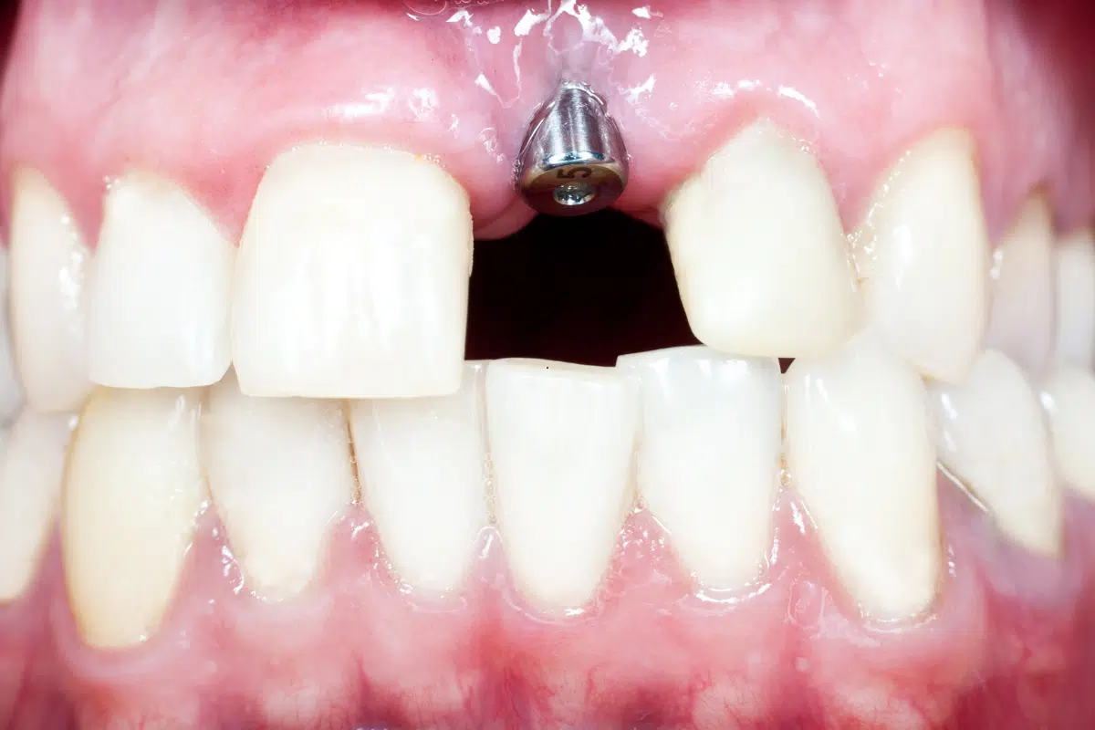 Dental Metals and MRI: Do Fillings & Crowns Heat Up?